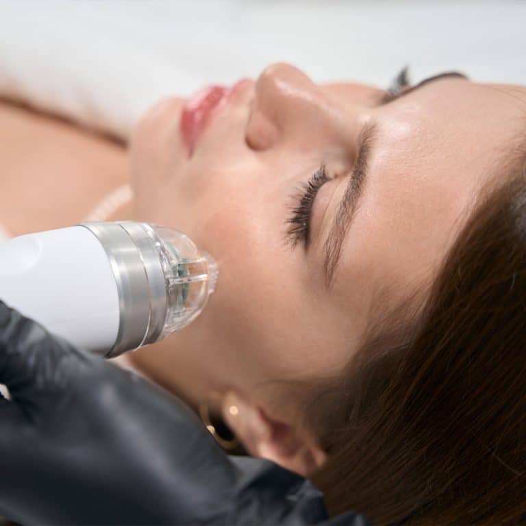 RF Microneedling in Bensalem, PA | Celestial Aesthetics